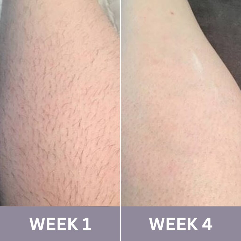 5 Best Laser Hair Removal Devices – Best Picks Today